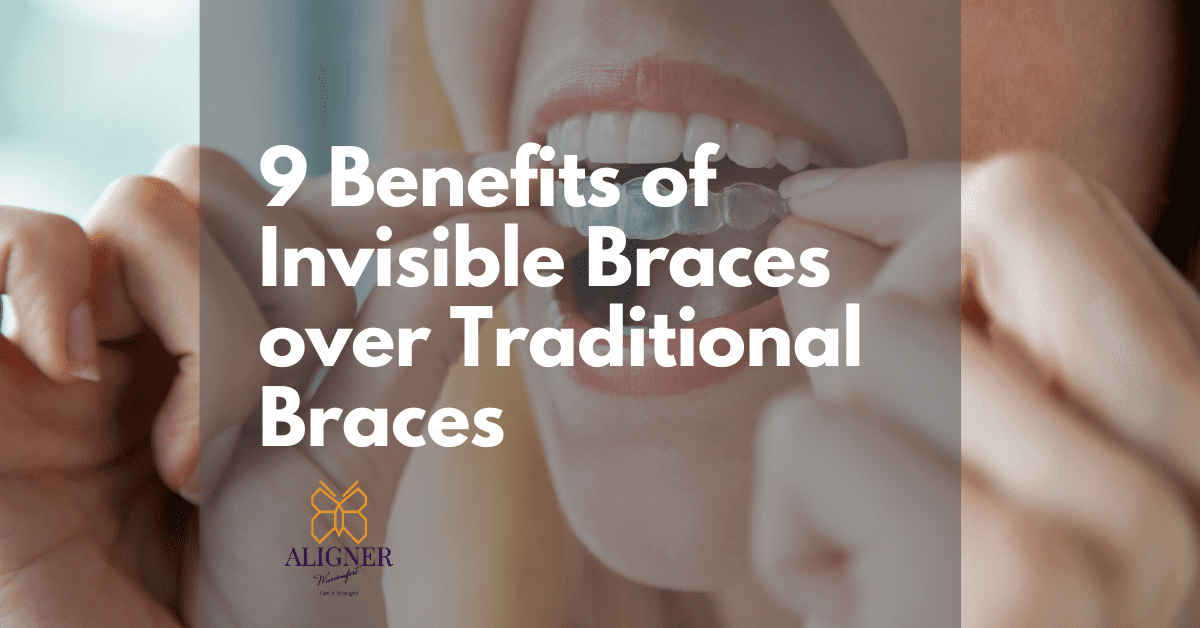 9 Benefits of Invisible Braces Over Traditional Braces