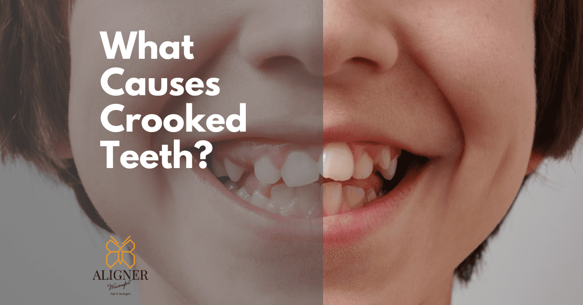 What Causes Crooked Teeth: How to Straighten it [2023]